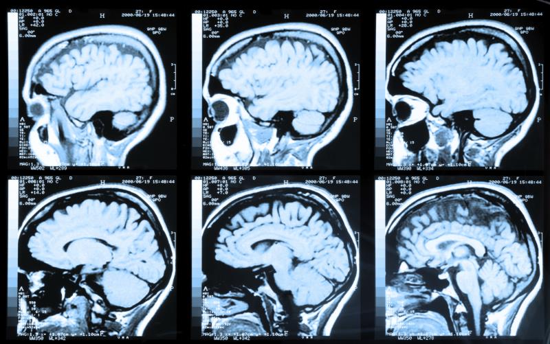 What Happens To The Brain When You Get A Headache LIVESTRONG COM what-happens-to-the-brain-when-you-get-a-headache-livestrong-com