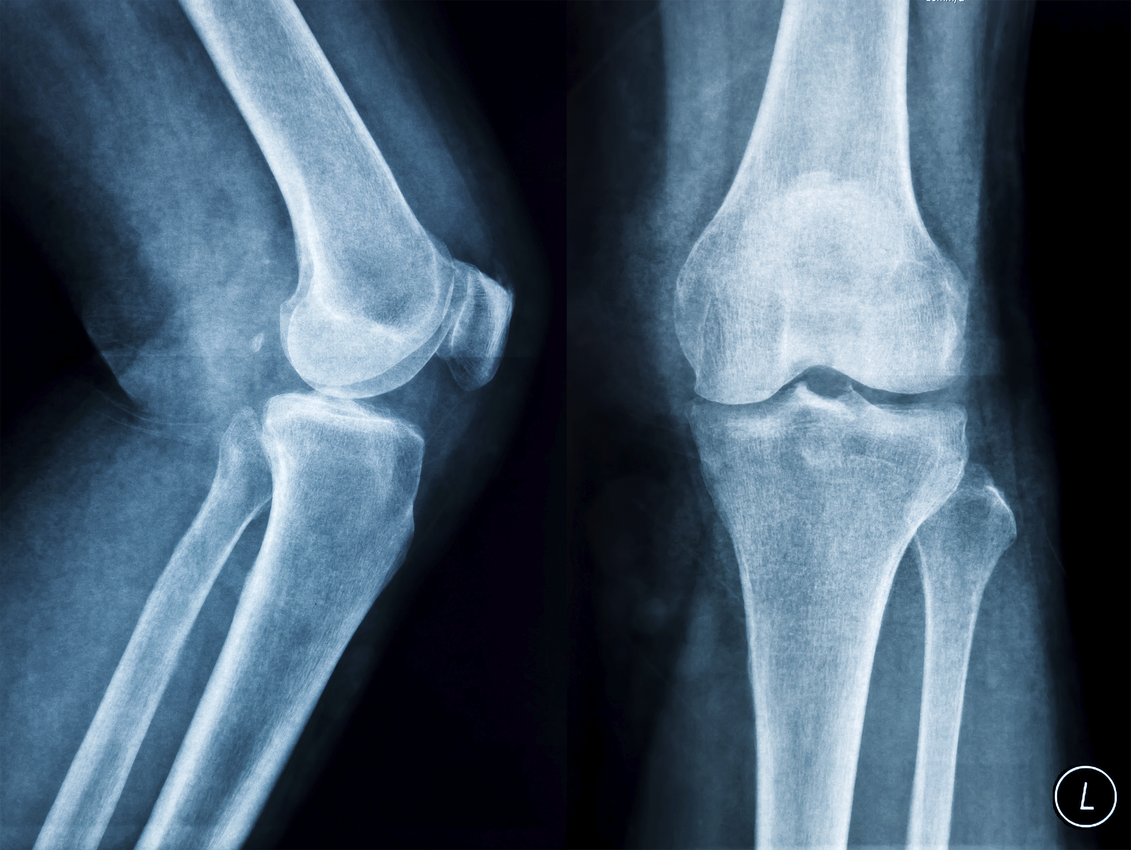 What Are The Treatments For Bone Spurs On The Leg Bone Healthfully