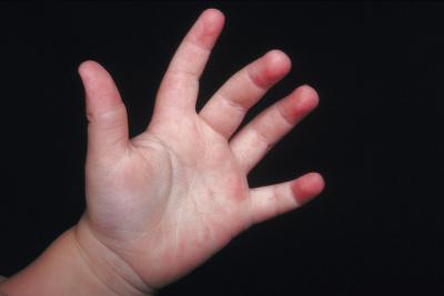 Painful Redness on the Hands and Feet in Children